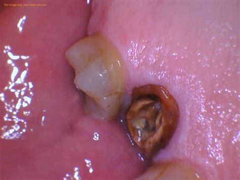 Root Canal Tooth Broke Off At Gum Line Treatment Options 1311 Jackson Ave Dental Dentist In