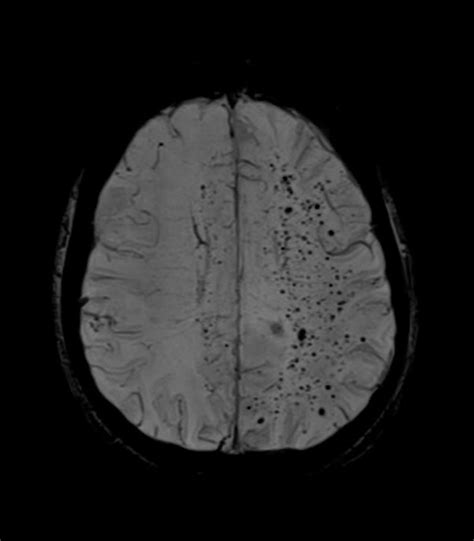 Cerebral Microhemorrhage Pacs