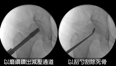 救救髖關節：核心減壓手術｜蔡尚聞醫師