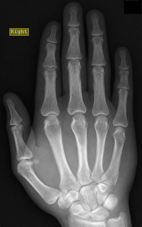 Broken Metacarpal X Ray