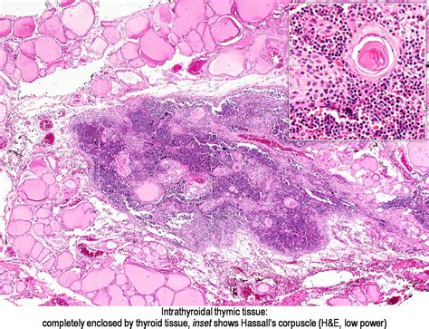 Pathology Outlines Thymic Tissue