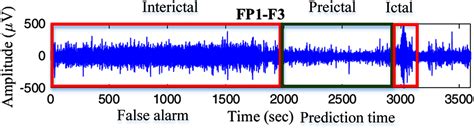 Prediction Of Epileptic Seizures Based On Multivariate Multiscale