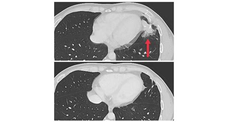 Immunotherapy Approach Shows Potential In Some People With Metastatic