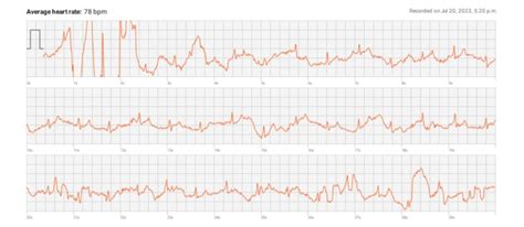 Possible Atrioventricular Node Abnormality R Medical