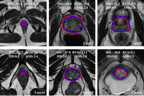 Qualitative Evaluation Of The Prostate Segmentation On Six Mr Volumes Download Scientific