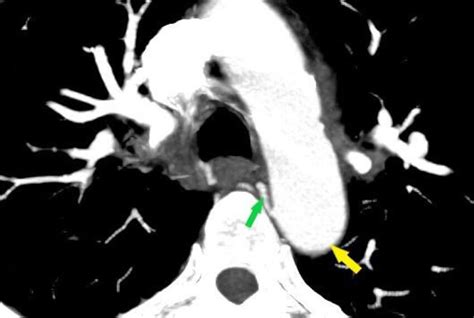 Preprocedural Ct Aortogram Showing The Origin Of The Right Bronchial Download Scientific