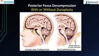 Improved Transcranial Motor Evoked Potentials After Craniovertebral