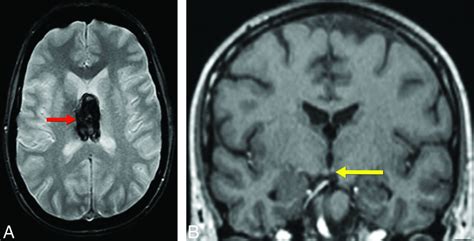 Fornix Brain Mri