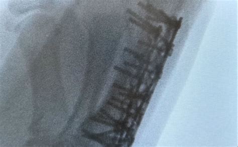Melbourne Arm Clinic Before ⬅️ 3 Previously Failed Internal Fixation Attempts For A Humeral