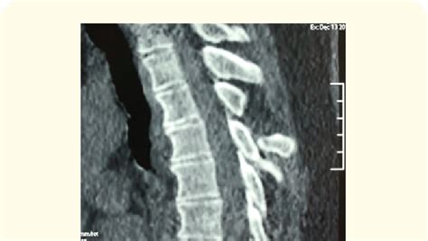 Ct Scan Imaging With Sagittal Reconstruction Download Scientific Diagram