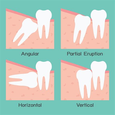 Are Impacted Wisdom Teeth Dangerous