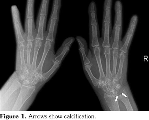 Acute Pseudogout Arthritis In A Patient Using Diuretics Pmc