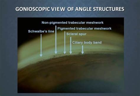 Gonioscopy Pptx Eye And Vision Conditions Diseases And Conditions
