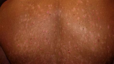 Itchy White Bumps On Skin White Bumps On Face Expert Explains The
