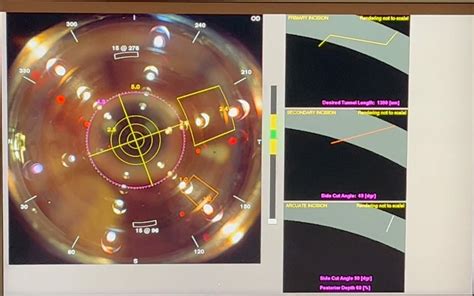 pearls of vision cataract comanagement skills part 1 optometry advisor