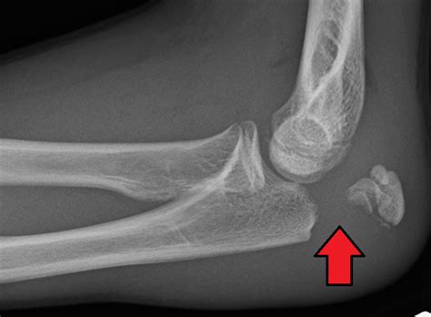 Olecranon Fracture Wikiwand