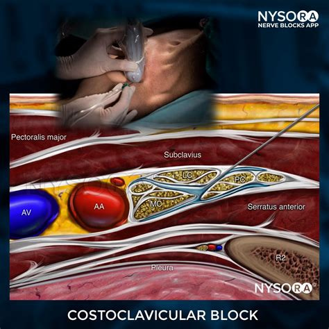 Infraclavicular Block