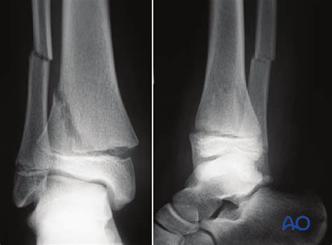 Epiphysiolysis With Metaphyseal Wedge Salter Harris Ii Of The Distal