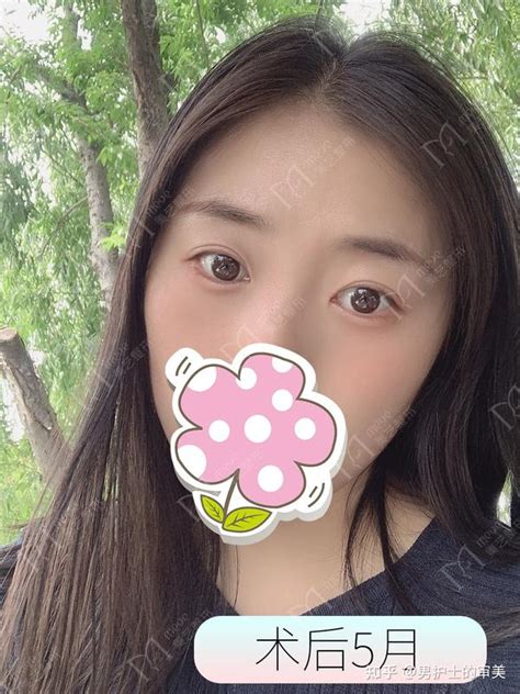 开扇双眼皮、平扇双眼皮区别在哪里？该怎么选择？ 知乎