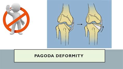 High Tibial Osteotomy Is Done For Treating Osteoarthritis Confined To