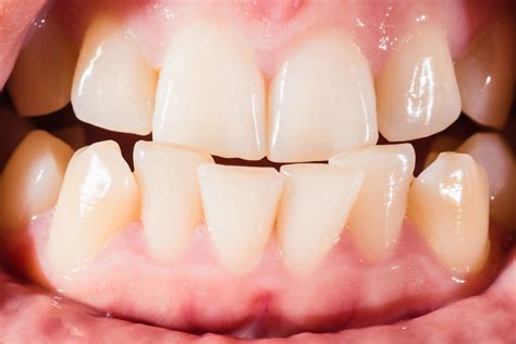 Lip Biting Meaning Causes Symptoms Images Bumps Swollen Lip From Biting And Treatment