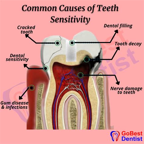 Tooth Sensitivity Treatment Natural At Marcus Glennie Blog