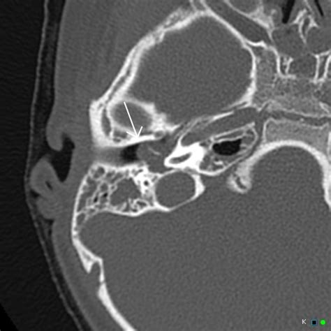 Tympanic Membrane Bulging With Fluid