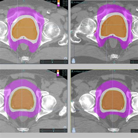 Prescription Isodose Surface Coverage For Off Axis Geometry Oag And Download Scientific