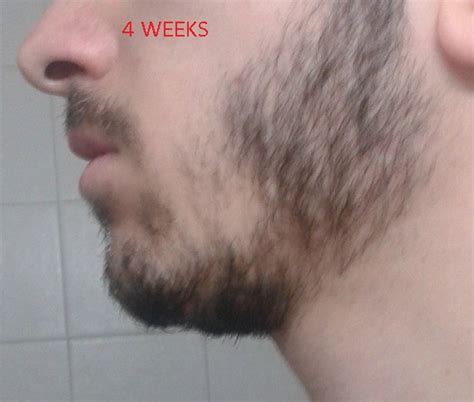 Patchy Beard Success Stories Before And After Photos Page Beard Board