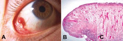 Pyogenic Granuloma Eye Symptoms