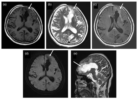 Scleroderma Endoscopy Findings At Randy Eubanks Blog