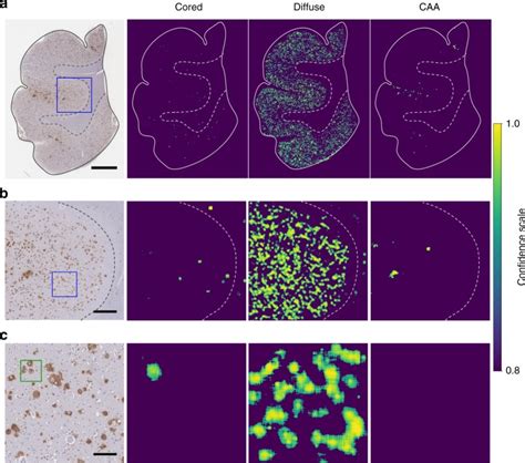 Interpretable Classification Of Alzheimers Disease Pathologies With A