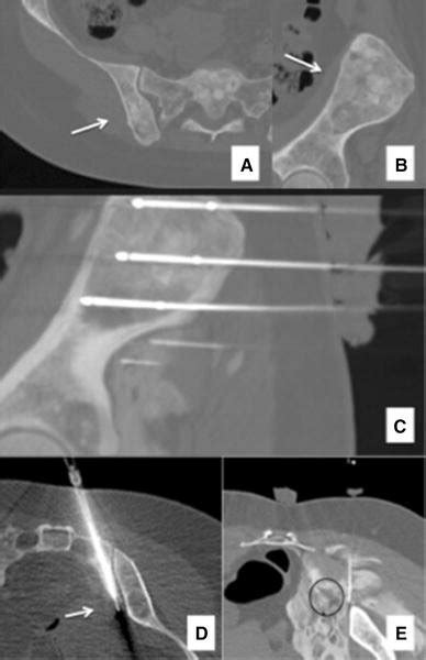 Thirty Eight Year Old Female With Diffuse Osteoblastic Disease From