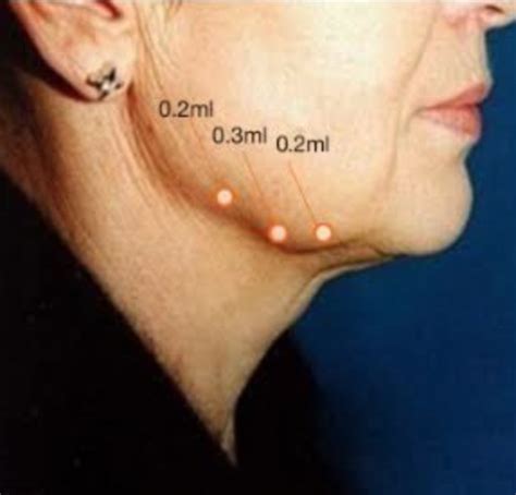 Botox For Jawline Instant Face Slimming With Botox Injections Artofit