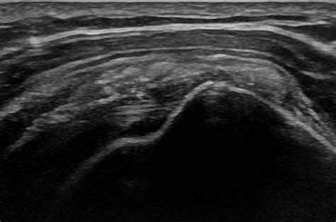 Musculoskeletal Joints And Tendons 61 Shoulder Case 6118 Bursa