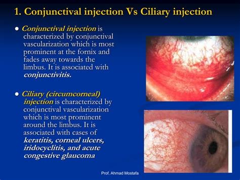 Diseases Of Conjunctiva Ppt