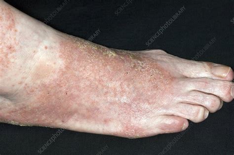 Infected Eczema On The Foot Stock Image C0083606 Science Photo Library