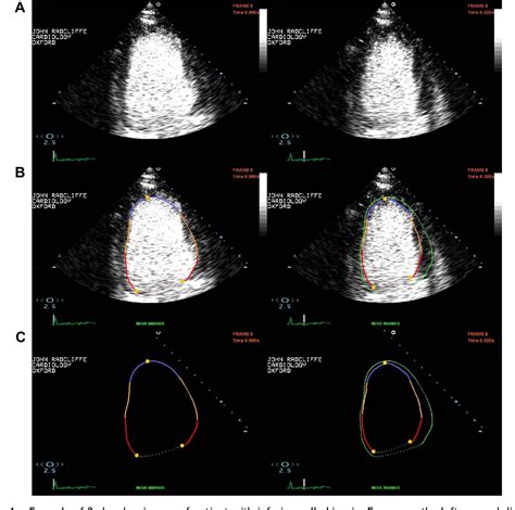 Figure 1 From Semi Automatic Boundary Detection To Improve Reporting Of Regional Left