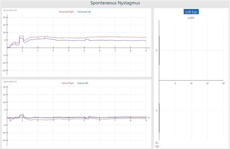 Visualeyes™ Spontaneous Nystagmus Interacoustics