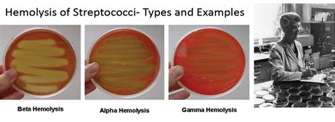 Strep A Throat Symptoms And Treatment 10 Important Facts
