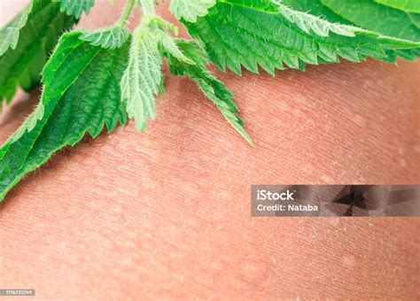 Plant Stinging Nettle Lying On Irritated Human Skin Covered With Small