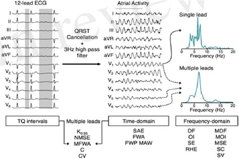 Overview Of Electrocardiogram Ecg Signal Processing And Complexity