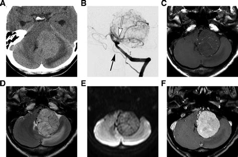 A Axial Head Computed Tomography At Level Of The Pons Reveals A Download Scientific Diagram