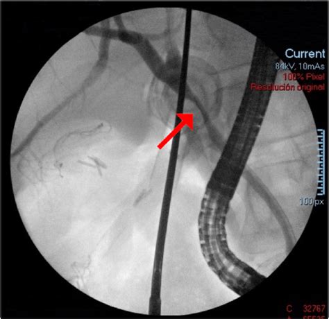 Intraoperative Ercp Showing Stenosis Of Cbd Red Arrow Showing Stenosis