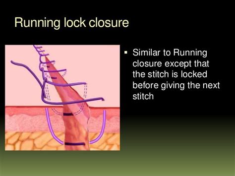 Sutures And Mesh