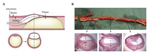 Histological Analysis Of A Long Term Patent Subintimal Canal In The