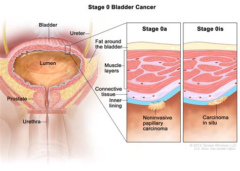 Bladder Cancer Treatment Pdq® Nci
