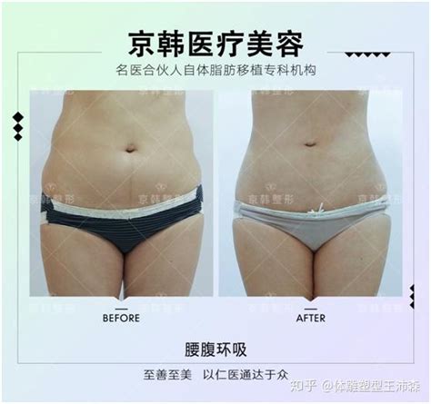 腰腹部吸脂凹凸不平皮肤松弛如何修复 知乎