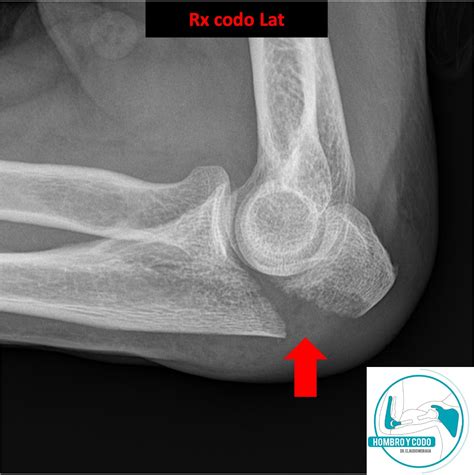 Fractura De Olecranon Causas Síntomas Y Opciones De Tratamiento