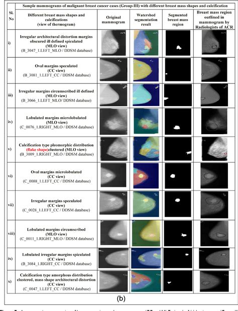 Figure 1 From Automated Multimodal Segmentation Of An Abnormal Breast Mass In Mammogram